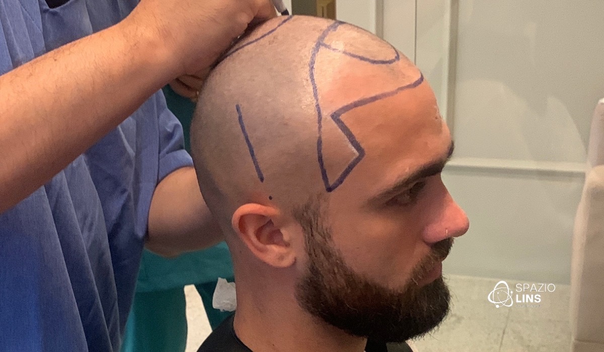 Como Saber se o Transplante Capilar é para Você? Guia Completo - Spazio Lins