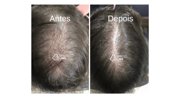 Mulher Pode Usar Finasterida? Entenda os Riscos e Benefícios - Spazio Lins