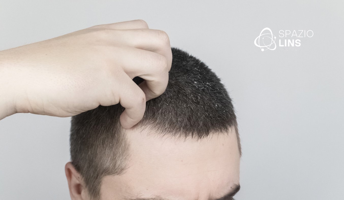 Foliculite Pós-Transplante Capilar: O Que Você Precisa Saber